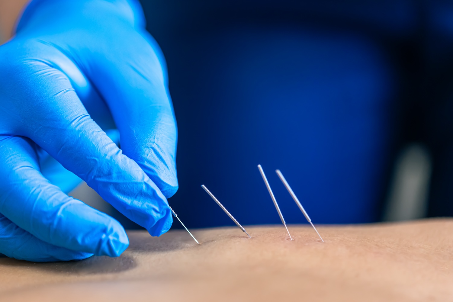 Dry Needling Therapy for Muscular Pain Relief in Kelowna